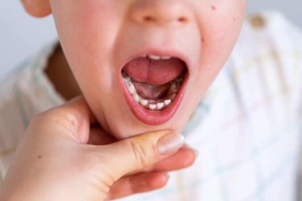 Shark Teeth in Kids: Causes, Signs & When to See a Dentist?